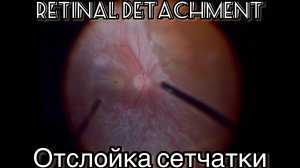Операция: отслойка сетчатки (Operation: retinal detachment)