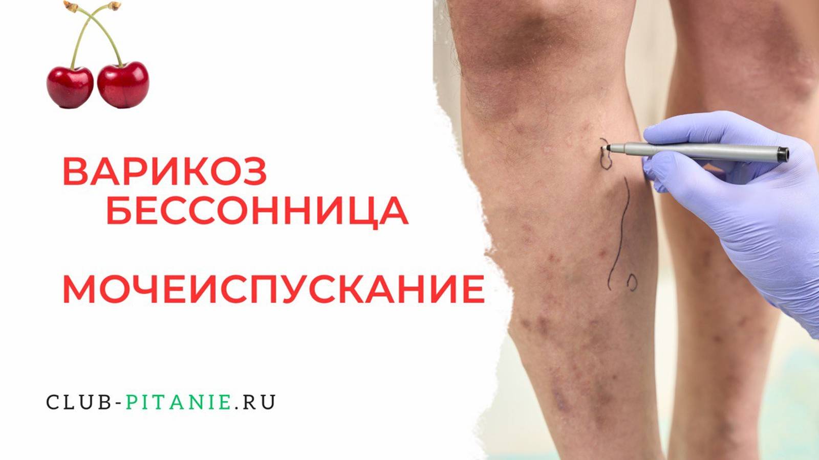 #АнализЗдоровья №122 Варикоз Бессонница Частое мочеиспускание