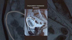 Опухолевое поражение брюшины на снимке КТ