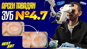 Реставрация зуба 4.7 | ReatART | Арсен Тавадян