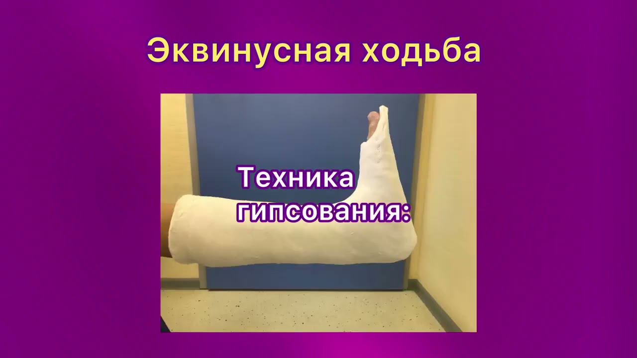 Эквинусная ходьба