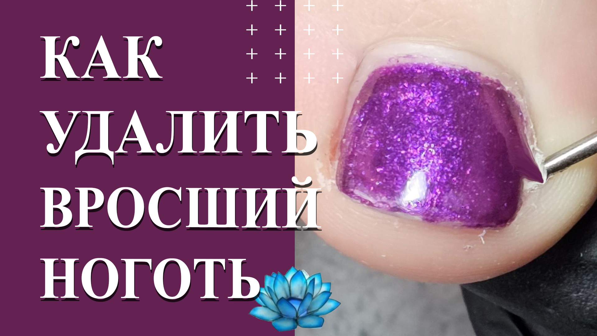 У клиента вросший ноготь на большом пальце ноги. Как убрать.