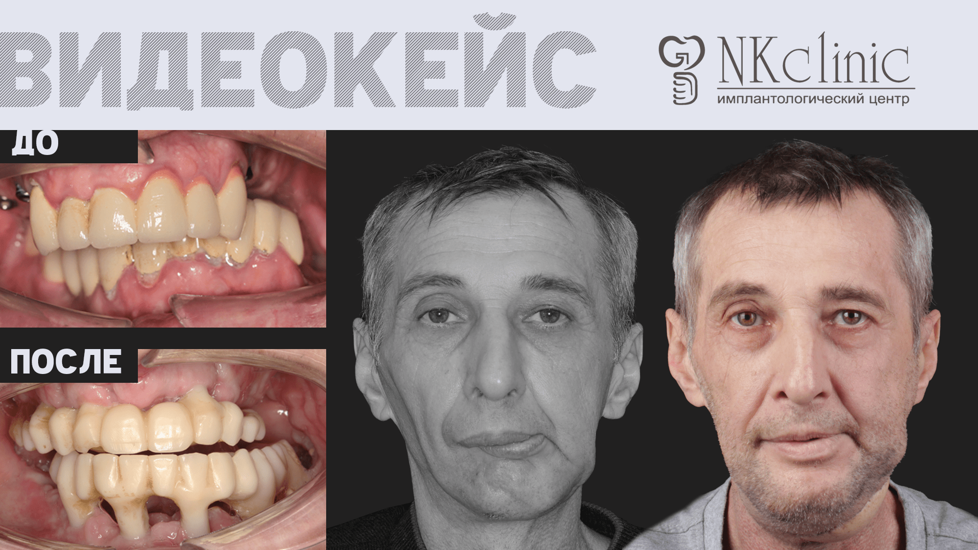 Опухоль (Рак) челюсти, микрохирургическая реконструкция