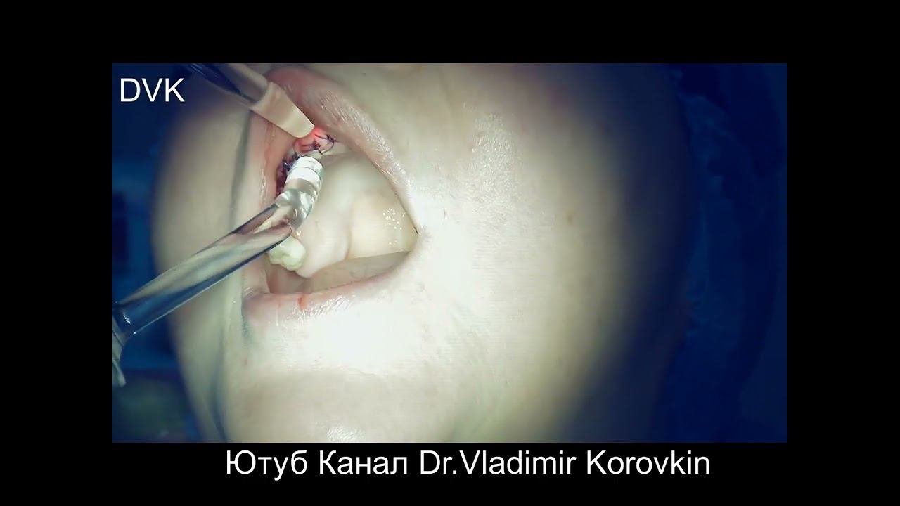 Сеанс лазеротерапии операционного поля.  ИК+КР  5 мин.