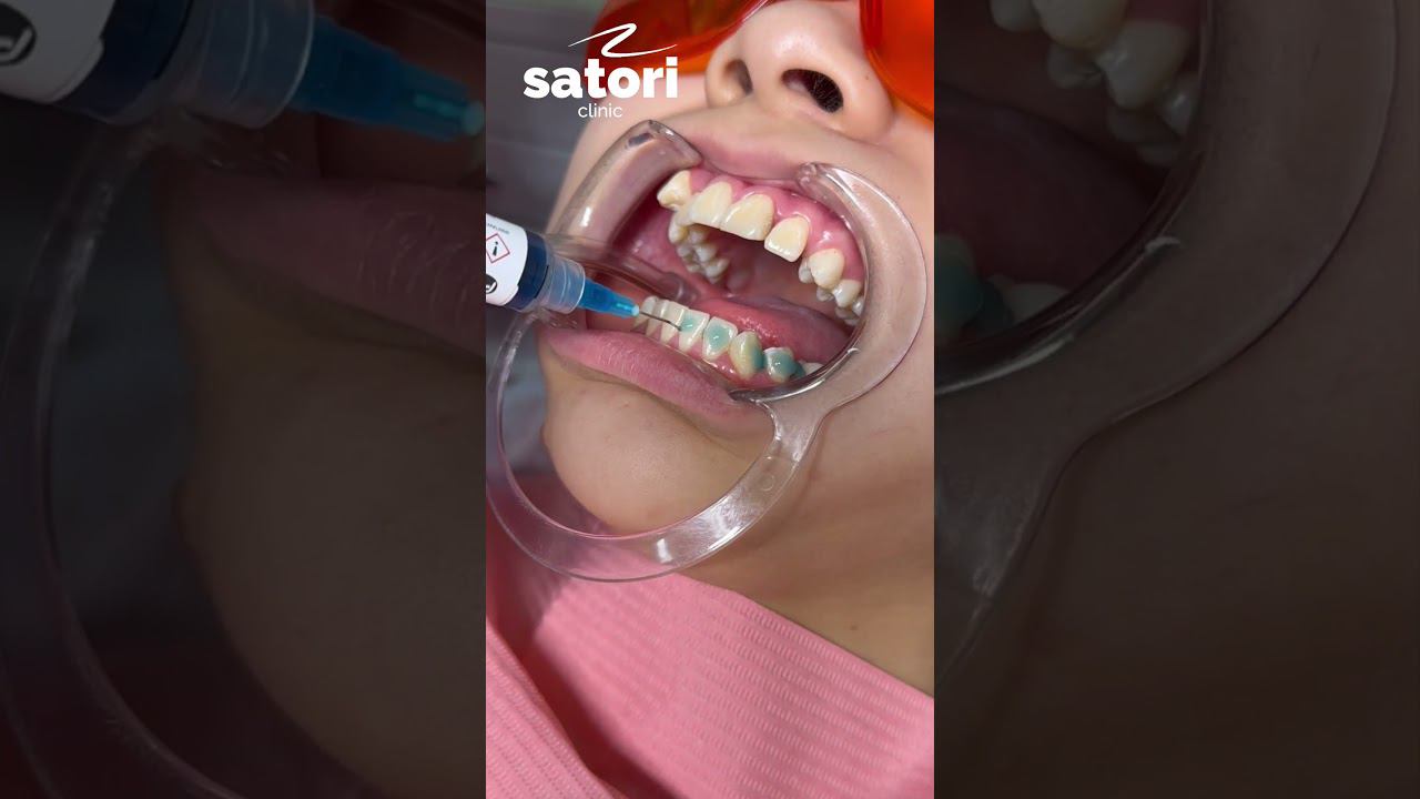 Операция по раскрытию ретинированного клыка  #стоматология #брекеты #braces