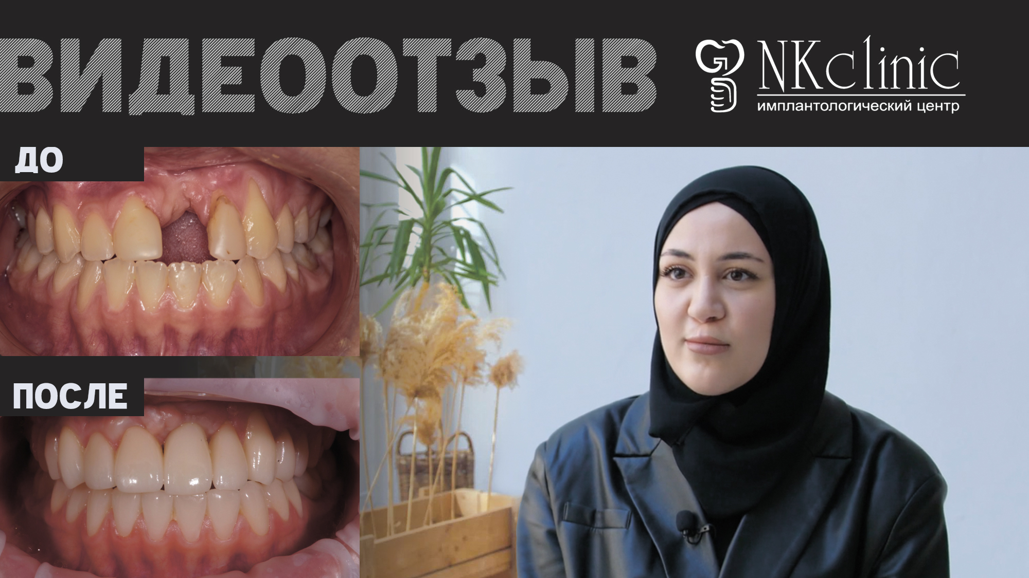 Как проходило лечение рецессии десны и нарушения прикуса