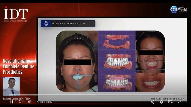Вебинар Michael Singer, DDS, FACP: революция в изготовлении полных съемных протезов.