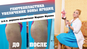 Глютеопластика. Увеличение зоны ягодиц
