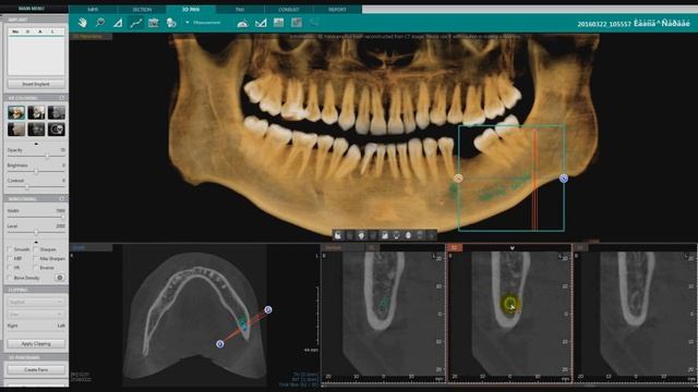 Прорисовка канала нижнечелюстного нерва