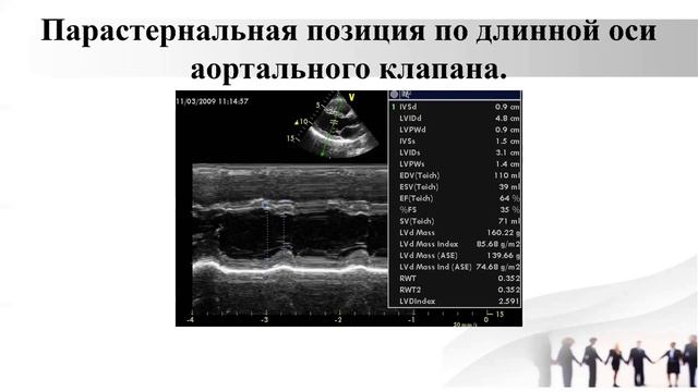 5 ЭХОКГ.mp4