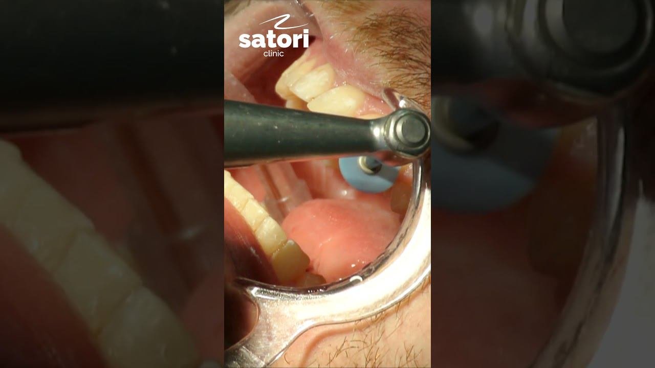 Снятие брекетов #брекеты #зубы #стоматологиясамара