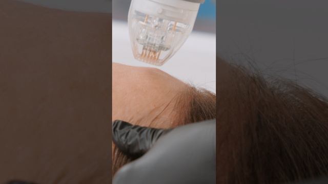 Пациенты, прошедшие курс RF-лифтинга VIVACE, всегда остаются довольны результатами
