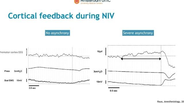 MV most important physiological concepts   Leo Heunks 2020