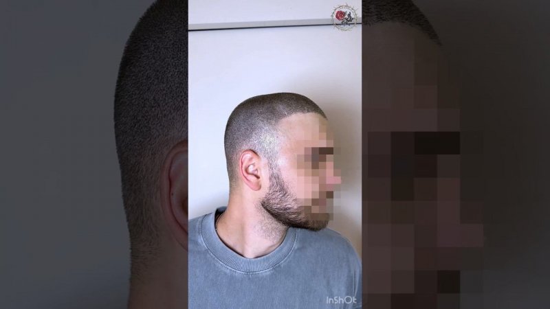 Трихопигментация после пересадки волос, макушка и шрам, инкогнито SMP scalp micropigmentation