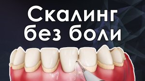 Удаление наддесневых отложений