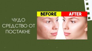 ЧУДО СРЕДСТВО ОТ ПОСТАКНЕ | КАК ИЗБАВИТЬСЯ ОТ ПРЫЩЕЙ