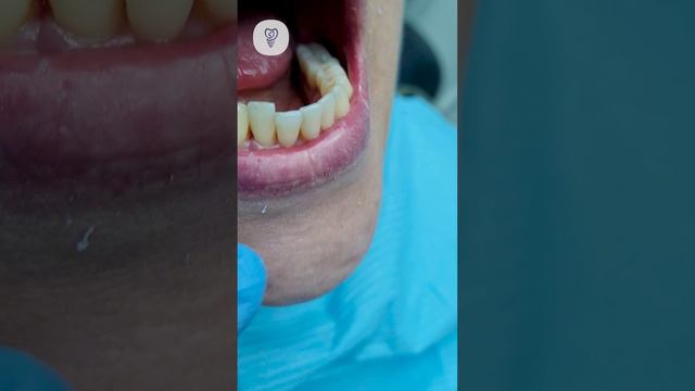 Настало время заняться эстетикой передних зубов. Имплантация Зубов. Имплантация Зубов.