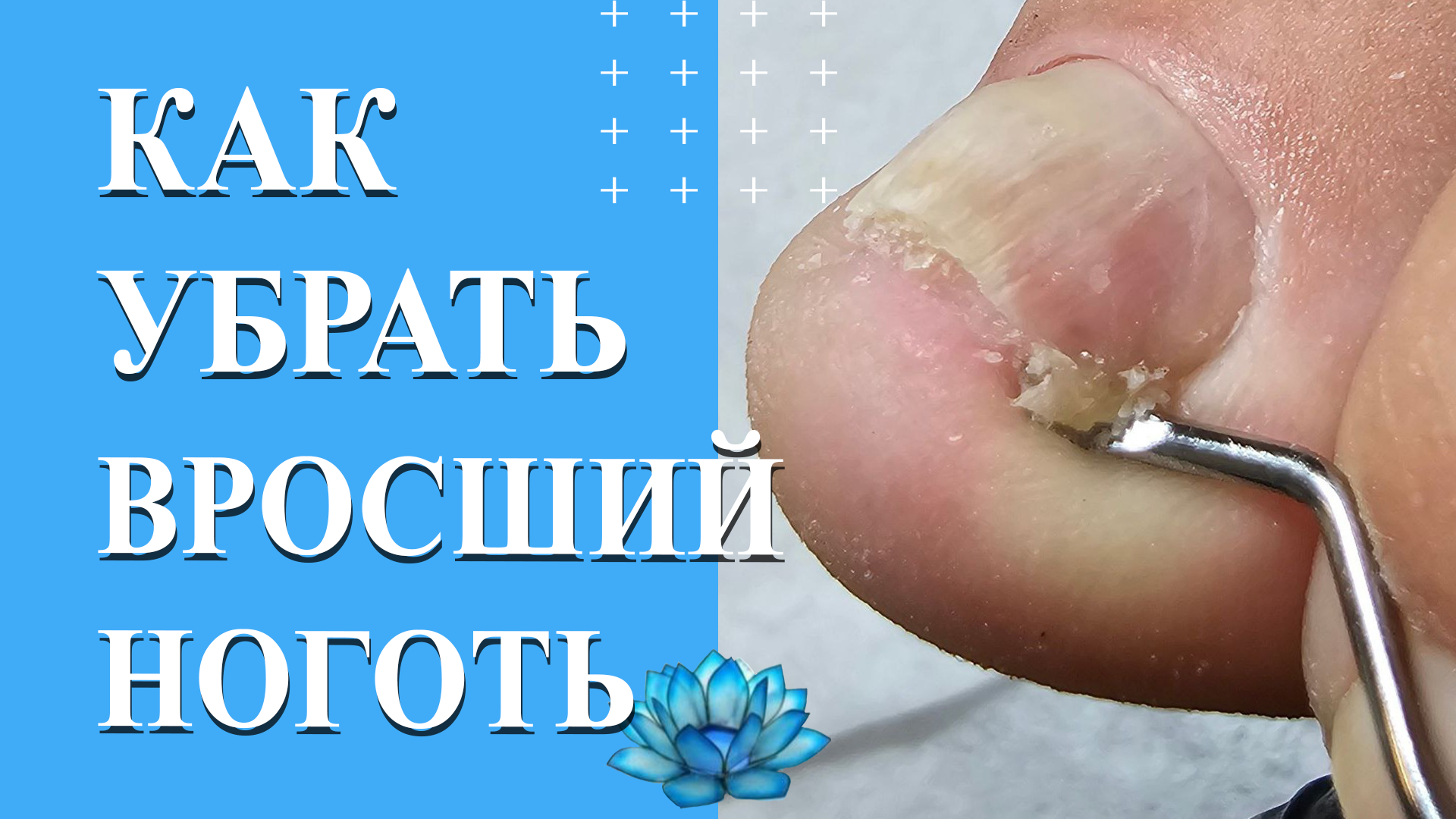 Вросший ноготь на большом пальце ноги. Удаление вросшего ногтя.