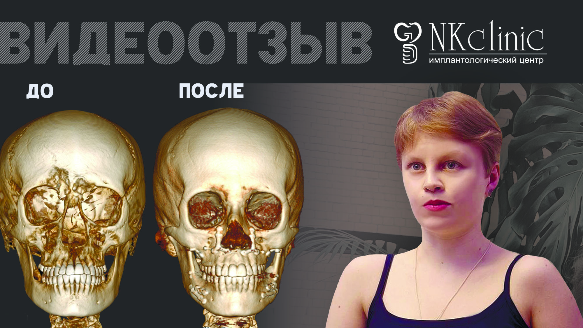 Лечение патологии прикуса на брекет-системе