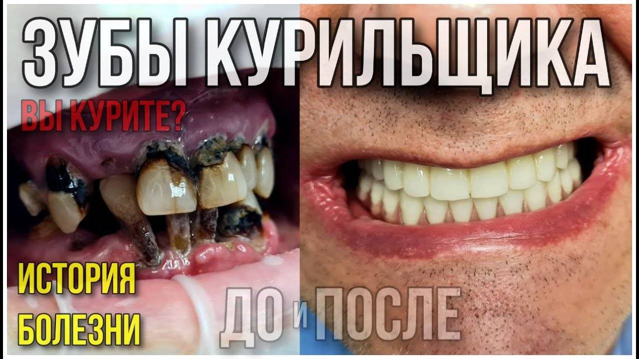 Зубы курильщика. Вы курите? Имплантация зубов. Первая стоматология.