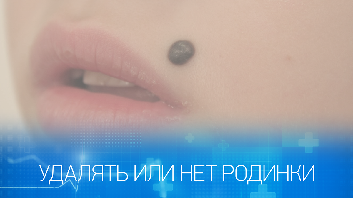 Нужно ли удалять родинки?
