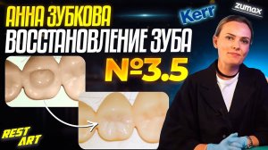 Восстановление зуба 3.5 | Реставрация второго премоляра | Анна Зубкова - RestART