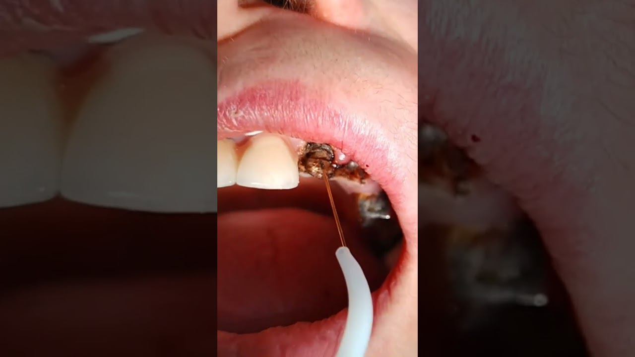Laser gingivectomy 22 tooth.#lasercutting #laserdentistry #laser