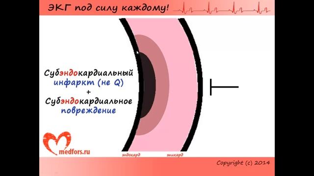 Урок 9. Видеокурс ЭКГ под силу каждому.