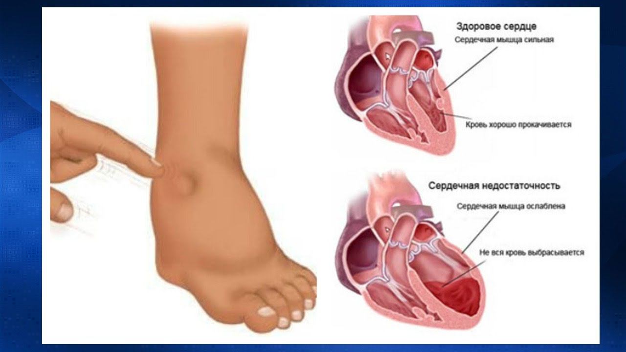 2.20 Массаж при последствиях инфаркта миокарда | Медицинский массаж. Цикл 2