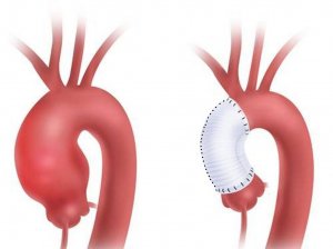 Екзопротезування висхідного відділу аорти
https://cardioservice.com.ua