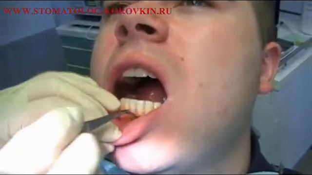 Laser Doppler flowmetry.Лазерная допплеровская флоуметрия при заболеваниях пародонта.mp4