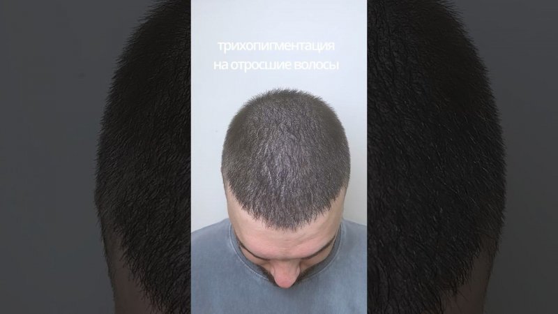 Трихопигментация на отросшие волосы после пересадки волос Уплотнили цвет Smp Scalp micropigmentation