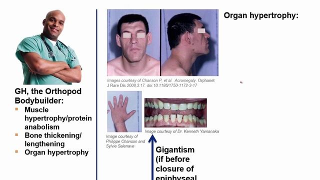 USMLE RX - 3.Эндокринная система - 3.Патология - 1.Акромегалия