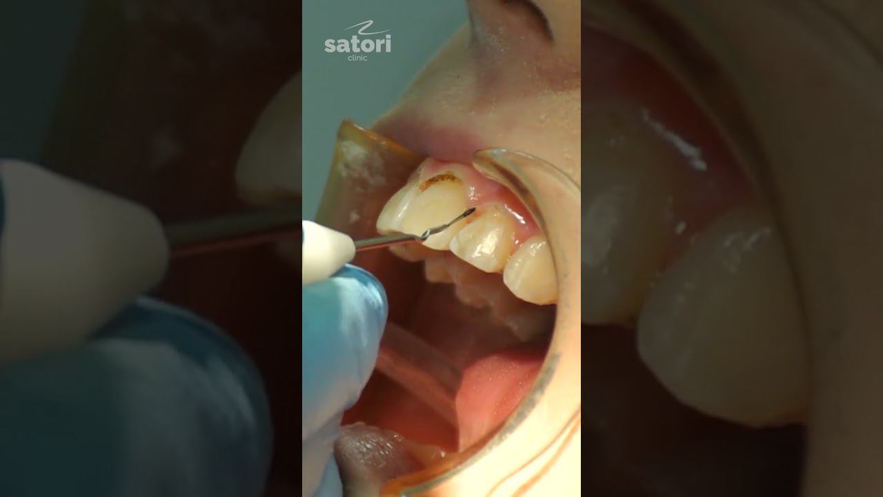 УДАЛЕНИЕ ГИПЕРТРОФИРОВАННОЙ ДЕСНЫ