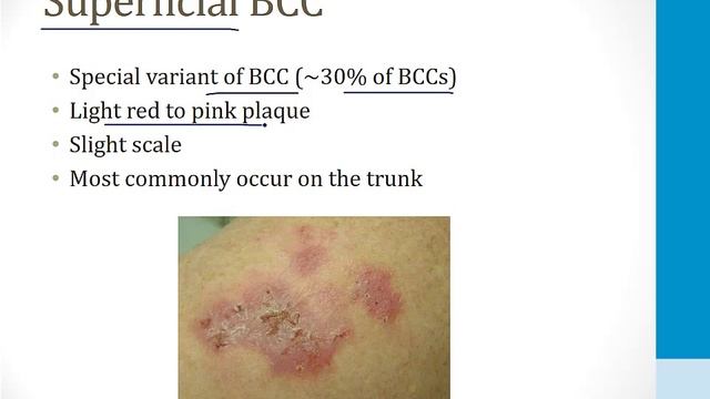 Дерматология USMLE - 1. Общие темы - 10.Рак кожи