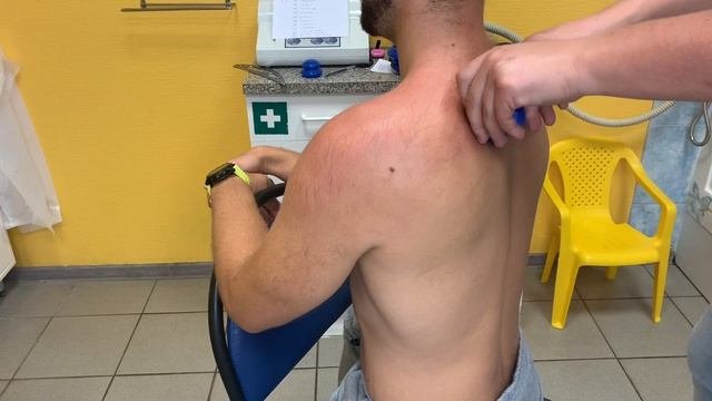 Инструментальная мобилизация, лимфодренажный массаж плеча при помощи вакуумных банок.Павел Коломиец.