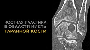 Костная пластика в области кисты таранной кости