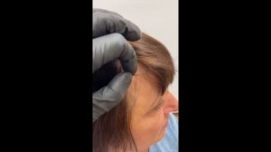 Baby hairs po kuracji preparatem Dr Cyj Hair Filler — Projekt Estetyka