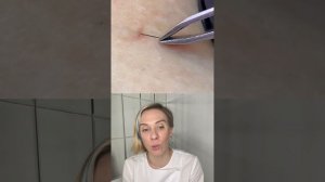 А у вас есть вросшие волосы?