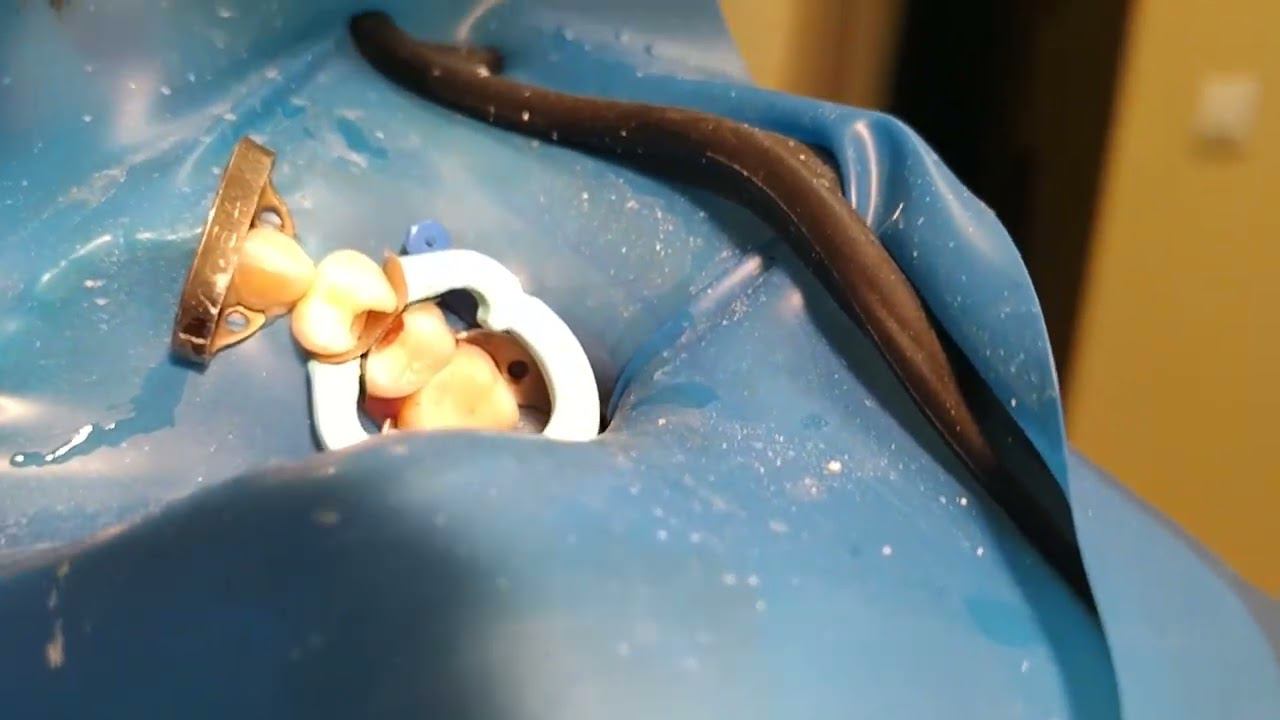 AO BO SI case. Caries  24-25.Make contact point. Ring Runa dent.