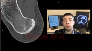 Перелом пяточной кости. Ролик №47