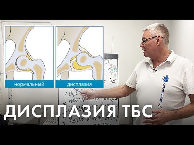 Дисплазия ТБС у новорожденных.