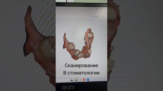 Сканирование подготовленных зубов с помощью сканера Medit под коронки