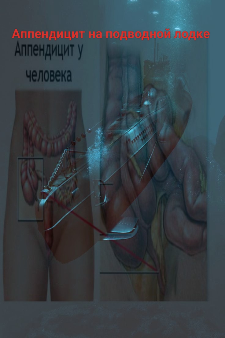 Аппендицит на подводной лодке.