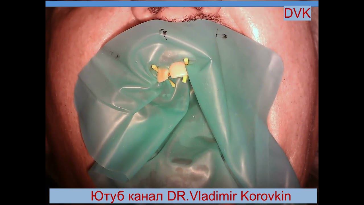 Изоляция 12,11 зубов без клампов.  Корды.