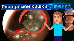 Рак прямой кишки. Лечение метод Watch and wait