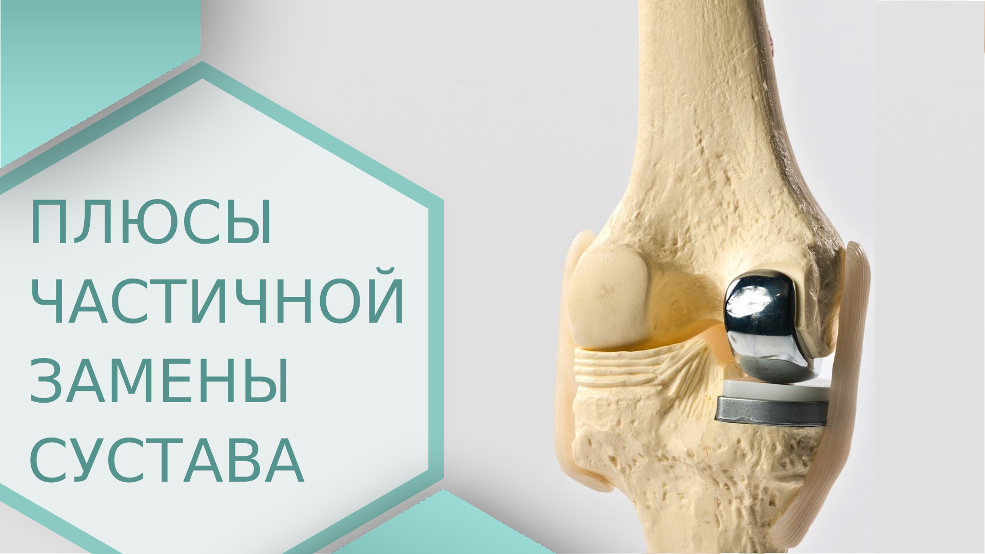 ? Преимущества одномыщелкового протезирования коленного сустава. Одномыщелковое протезирование. 18+