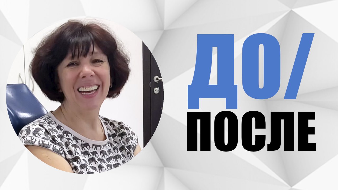 #4 Случай. Ортодонтическая подготовка с последующей установкой виниров и имплантанта. Гранцев М.М.