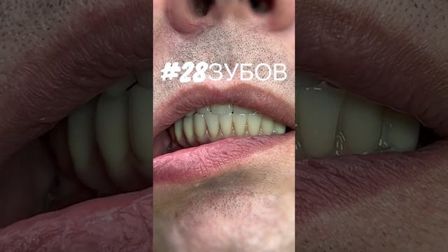 Видео-отзыв: До и После после операции.Имплантация зубов под ключ за один день с постоянным протезом