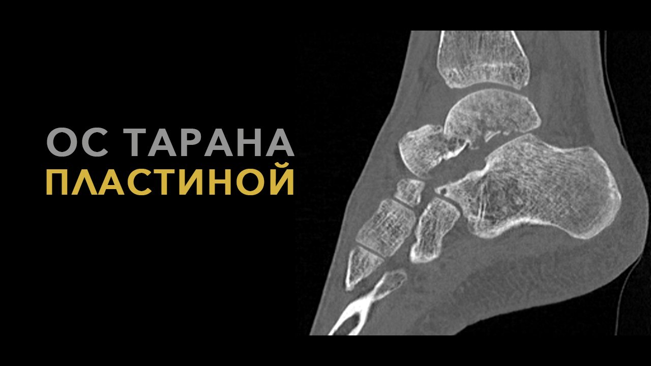 ОС тарана пластиной